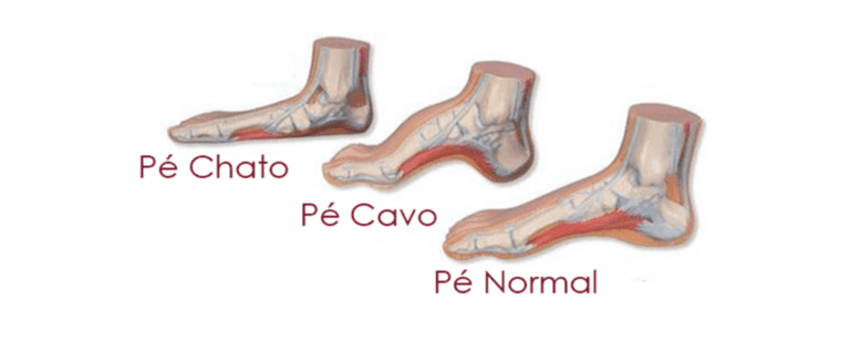 Pé Cavo: sinais, tratamento, prevenção e recuperação