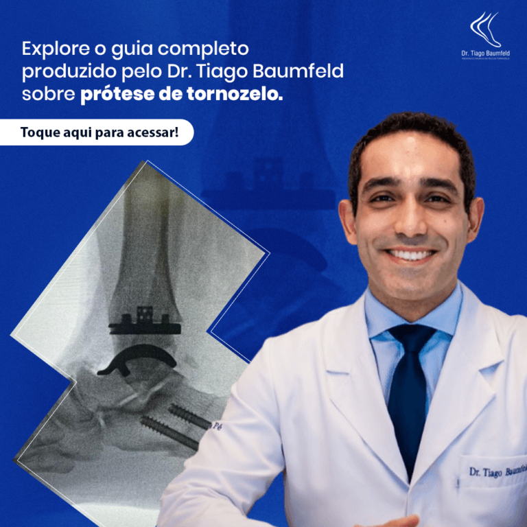 Torci o tornozelo, o que fazer? Tiago Baumfeld